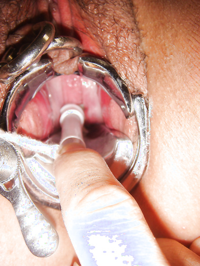 Tampon In Cervix 1 Image 603556 Thisvid Tube
