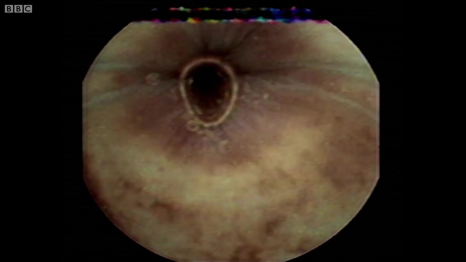 Pill Camera Swallowed