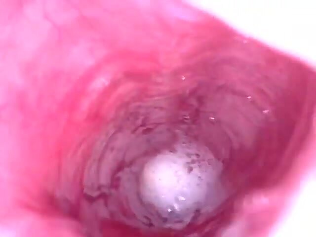 Esophagus Cam