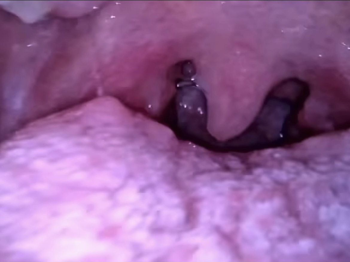Quick Endoscope Tour Inside A Cute Brunettes Mouth