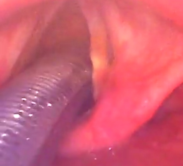 Trachea Cannula